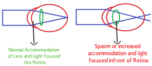 Myopia- Everything you need to know. - Smart Optometry