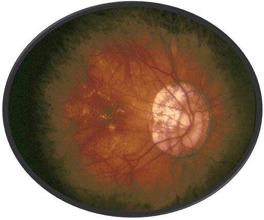 Myopia- Everything you need to know. - Smart Optometry