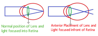 Myopia- Everything you need to know. - Smart Optometry