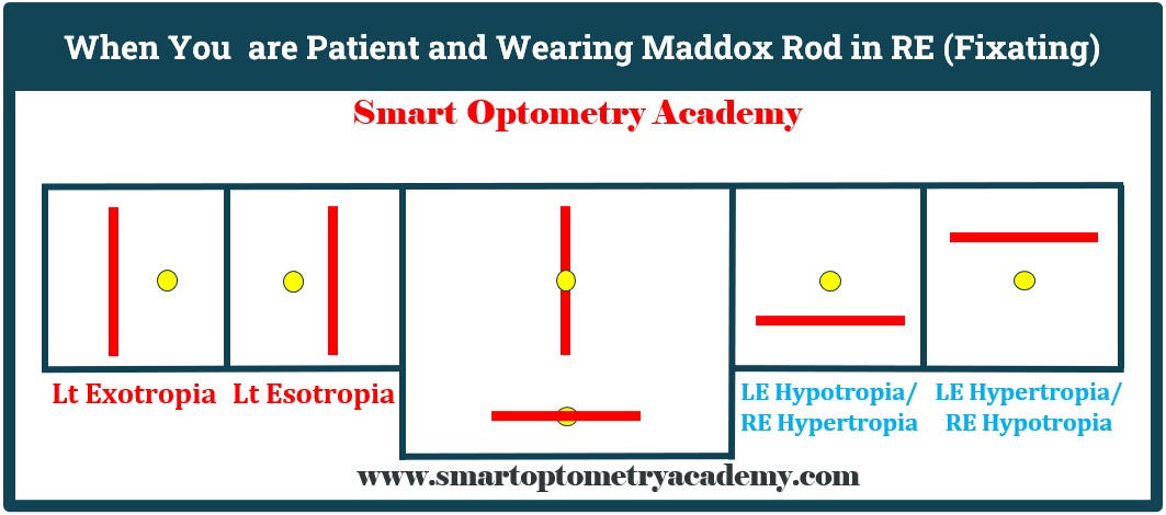 Maddox Rod Test- Everything You Need to Know. - Smart Optometry