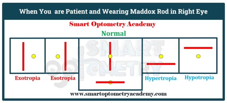 Maddox Rod Test- Everything You Need to Know. - Smart Optometry