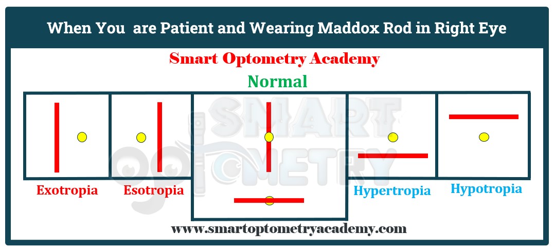 Maddox Rod Test- Everything You Need to Know. - Smart Optometry