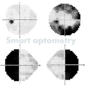 Perimetry or Visual Field Analysis- An Overview. - Smart Optometry