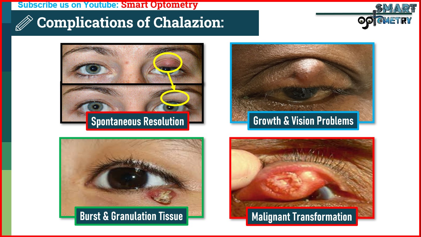 Chalazion- Definition, Mechanism, Causes, Symptoms, Signs, Treatment ...