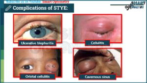 External Hordeolum or Stye- Everything you Need to Know - Smart Optometry