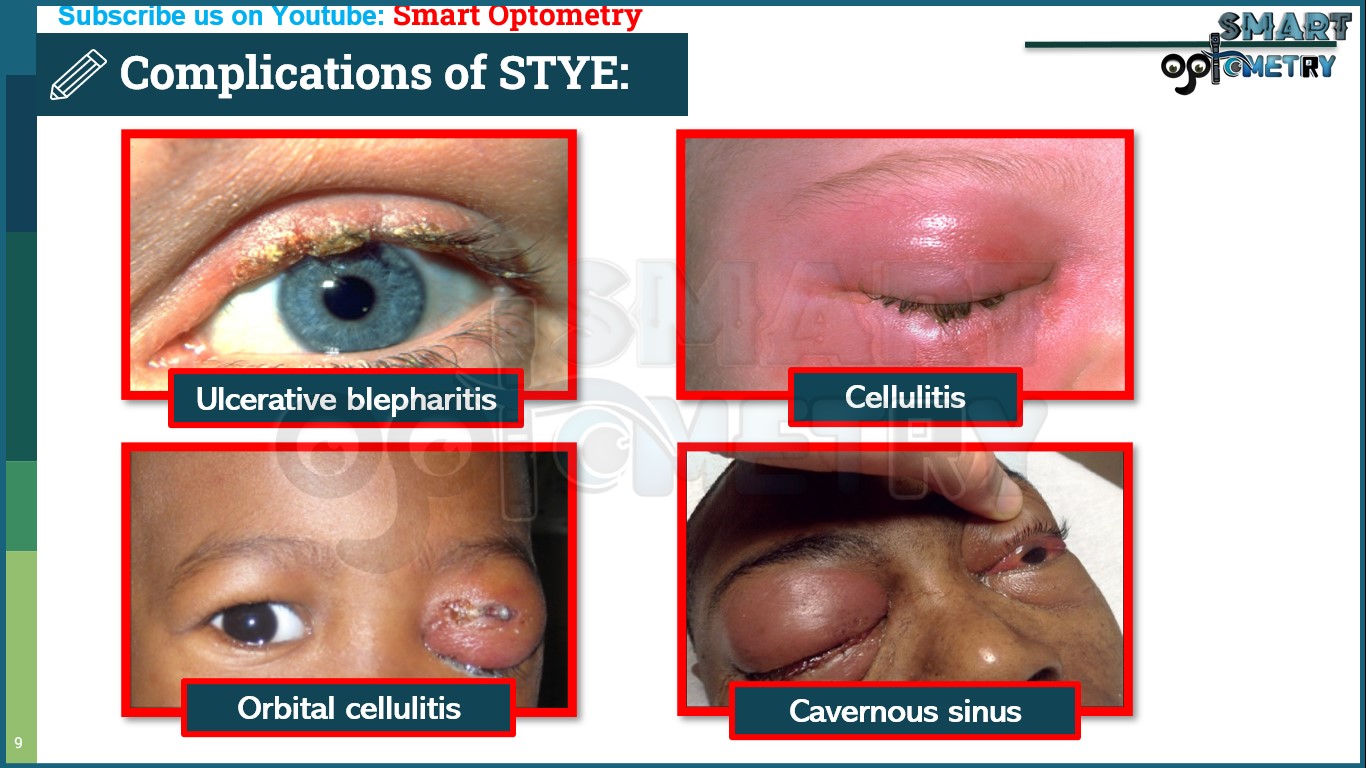 External Hordeolum or Stye- Everything you Need to Know - Smart Optometry