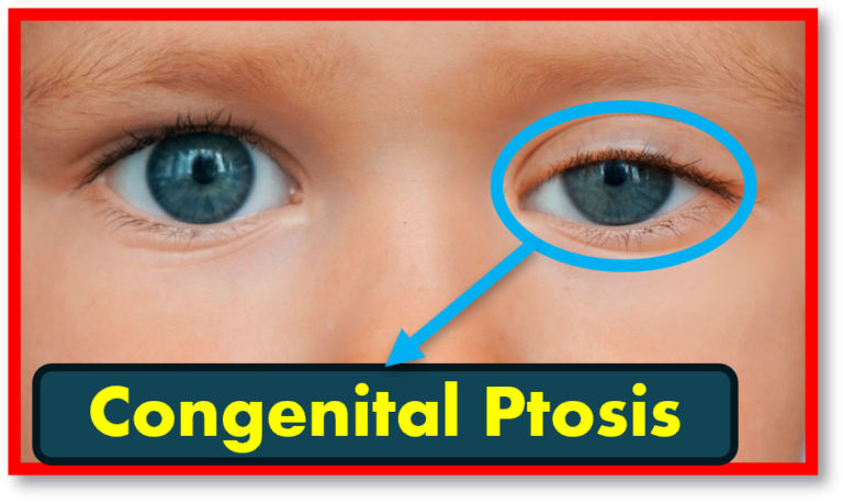 6 Congenital Anomalies of Eyelid- Every Optometrists Should Know ...