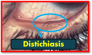 6 Congenital Anomalies of Eyelid- Every Optometrists Should Know ...