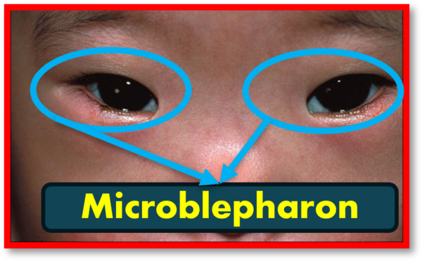 6 Congenital Anomalies of Eyelid- Every Optometrists Should Know ...