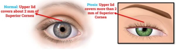 6 Congenital Anomalies of Eyelid- Every Optometrists Should Know ...