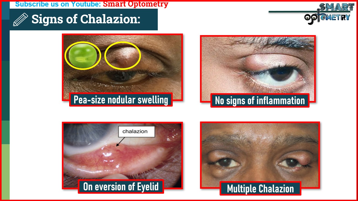 Chalazion- Definition, Mechanism, Causes, Symptoms, Signs, Treatment ...