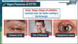 External Hordeolum or Stye- Everything you Need to Know - Smart Optometry