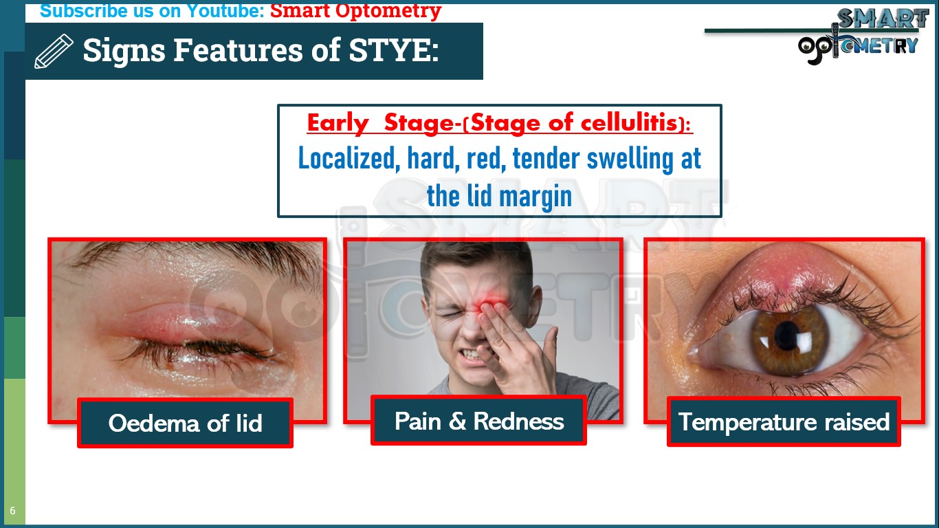 External Hordeolum or Stye- Everything you Need to Know - Smart Optometry
