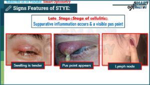 External Hordeolum or Stye- Everything you Need to Know - Smart Optometry