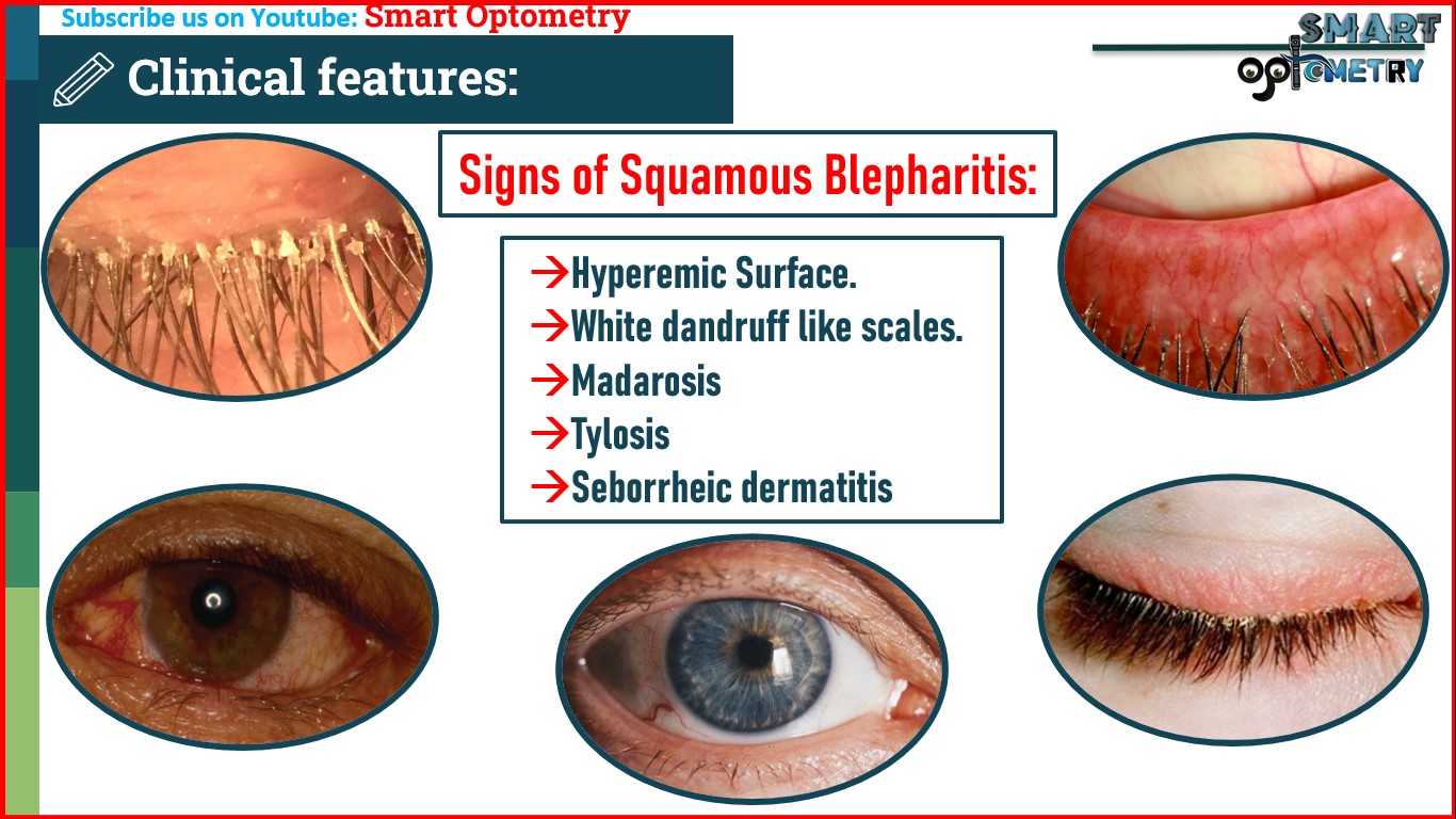 Blepharitis – Introduction, Causes, Symptoms, Signs, Treatment & Complications. - Smart Optometry