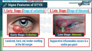 External Hordeolum or Stye- Everything you Need to Know - Smart Optometry