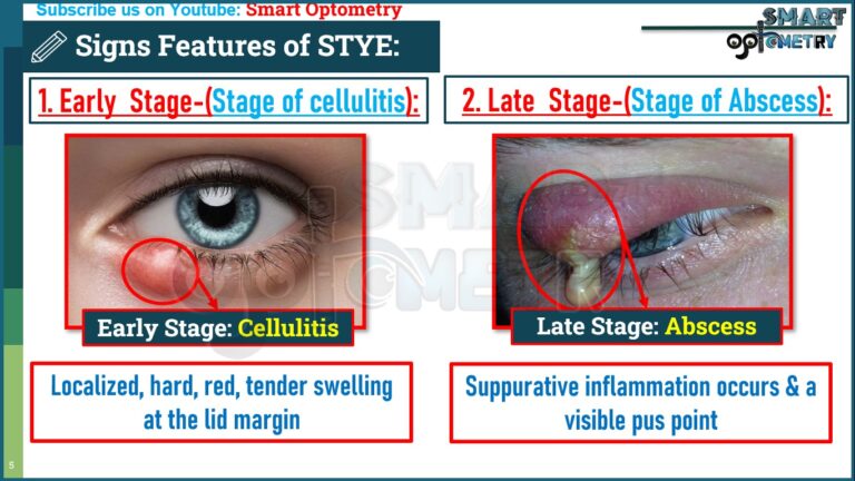External Hordeolum or Stye- Everything you Need to Know - Smart Optometry