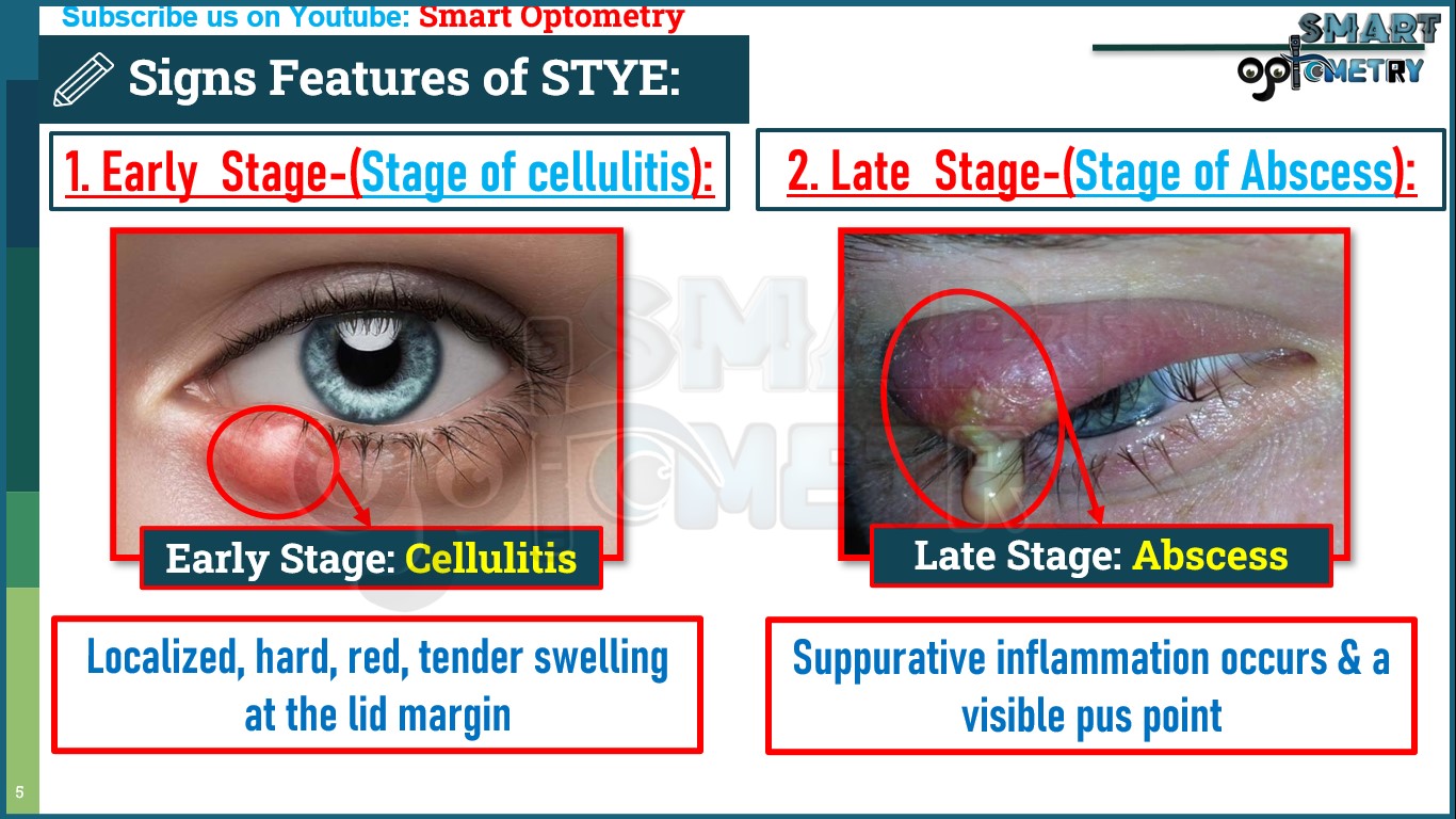 External Hordeolum or Stye- Everything you Need to Know - Smart Optometry