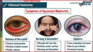 Blepharitis – Introduction, Causes, Symptoms, Signs, Treatment ...