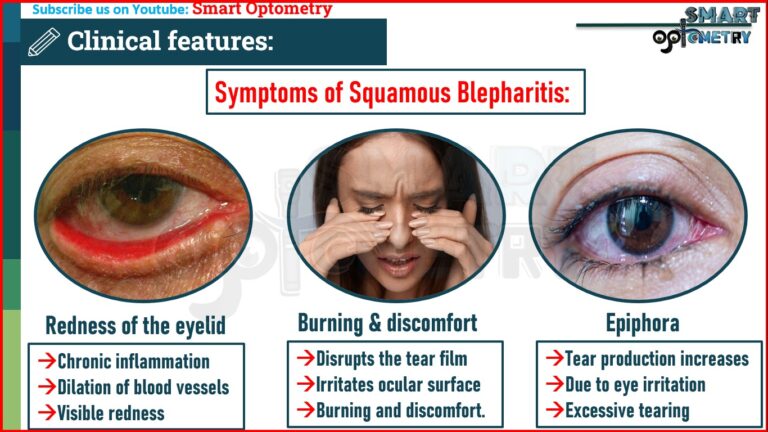 Blepharitis – Introduction, Causes, Symptoms, Signs, Treatment & Complications. - Smart Optometry
