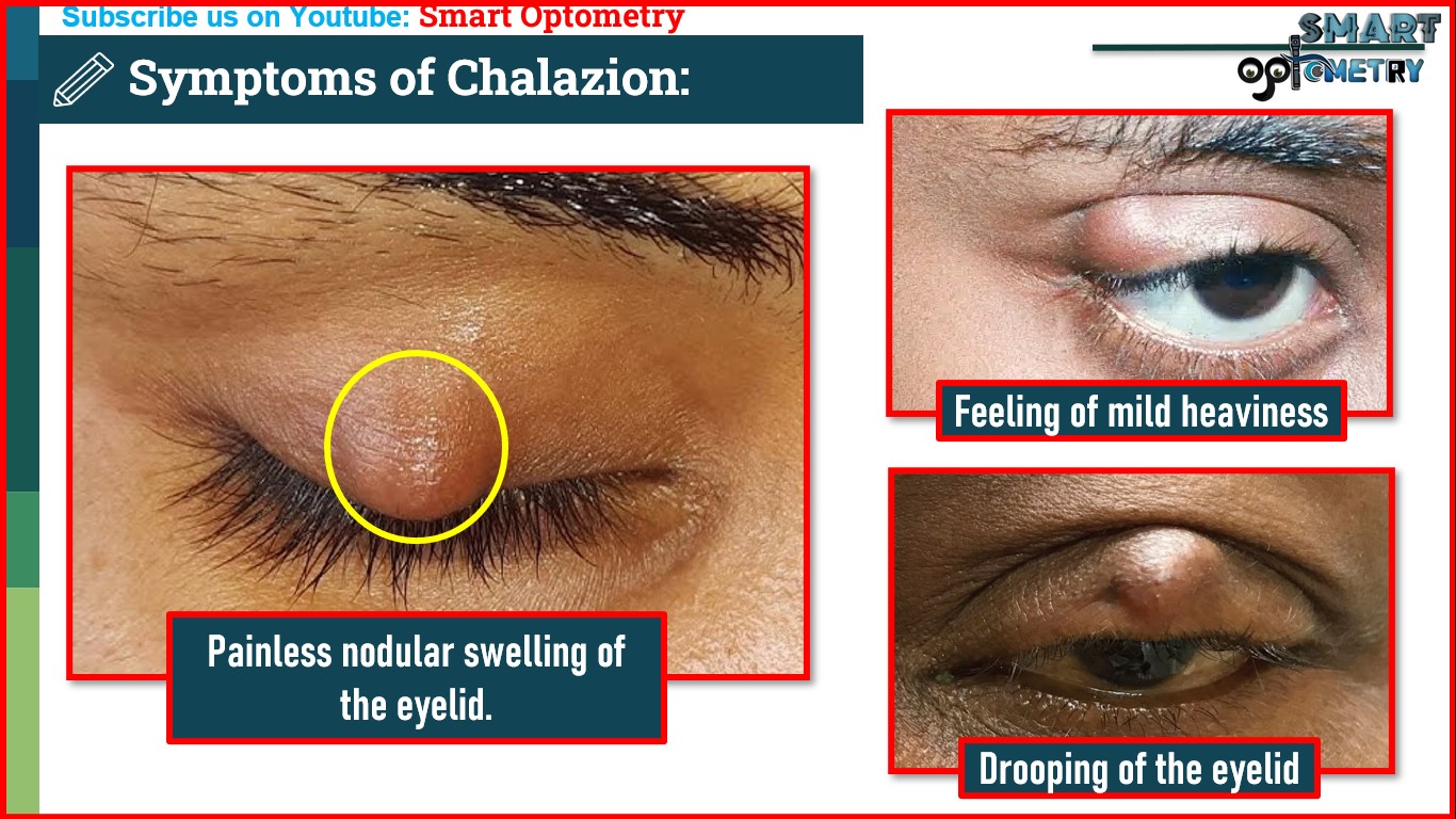 Chalazion- Definition, Mechanism, Causes, Symptoms, Signs, Treatment ...