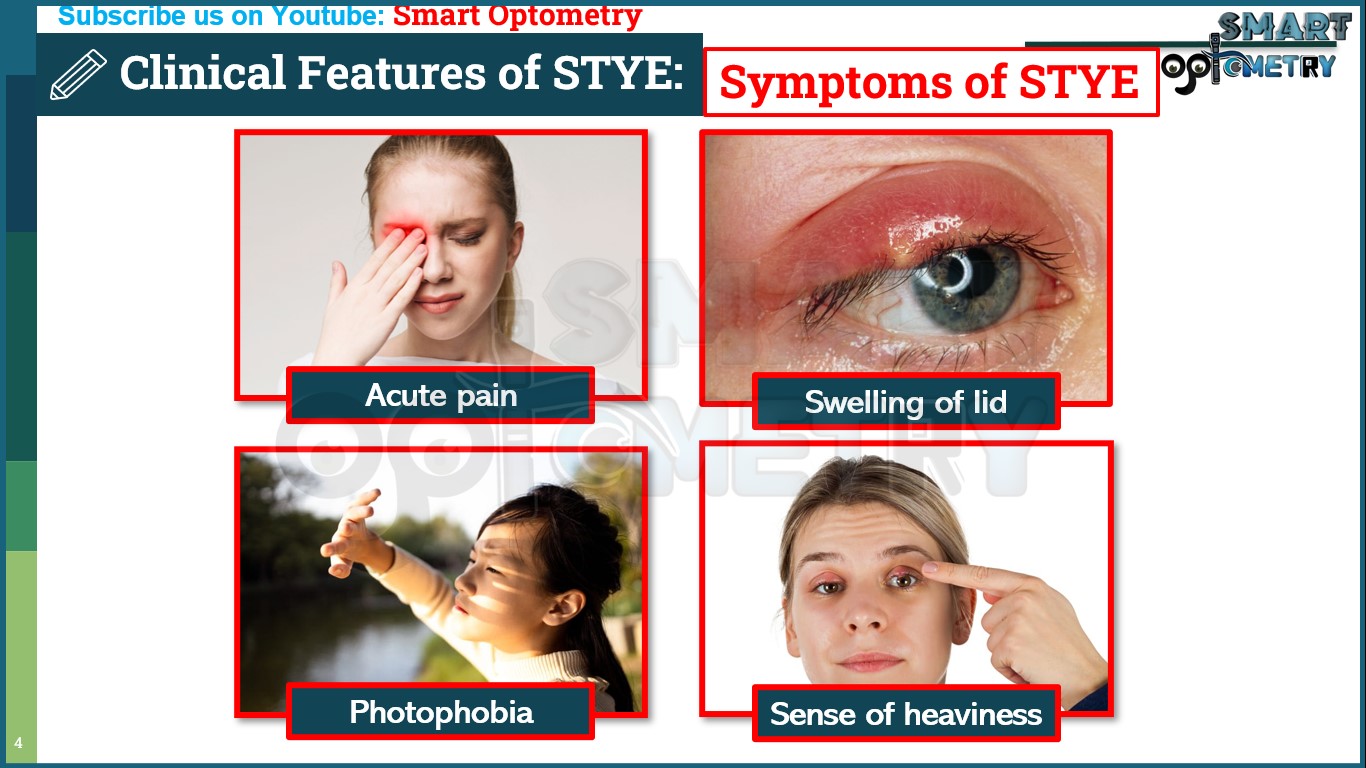 External Hordeolum or Stye- Everything you Need to Know - Smart Optometry