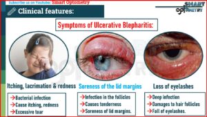 Blepharitis – Introduction, Causes, Symptoms, Signs, Treatment ...
