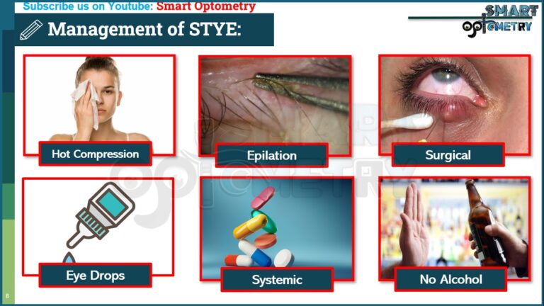 External Hordeolum or Stye- Everything you Need to Know - Smart Optometry