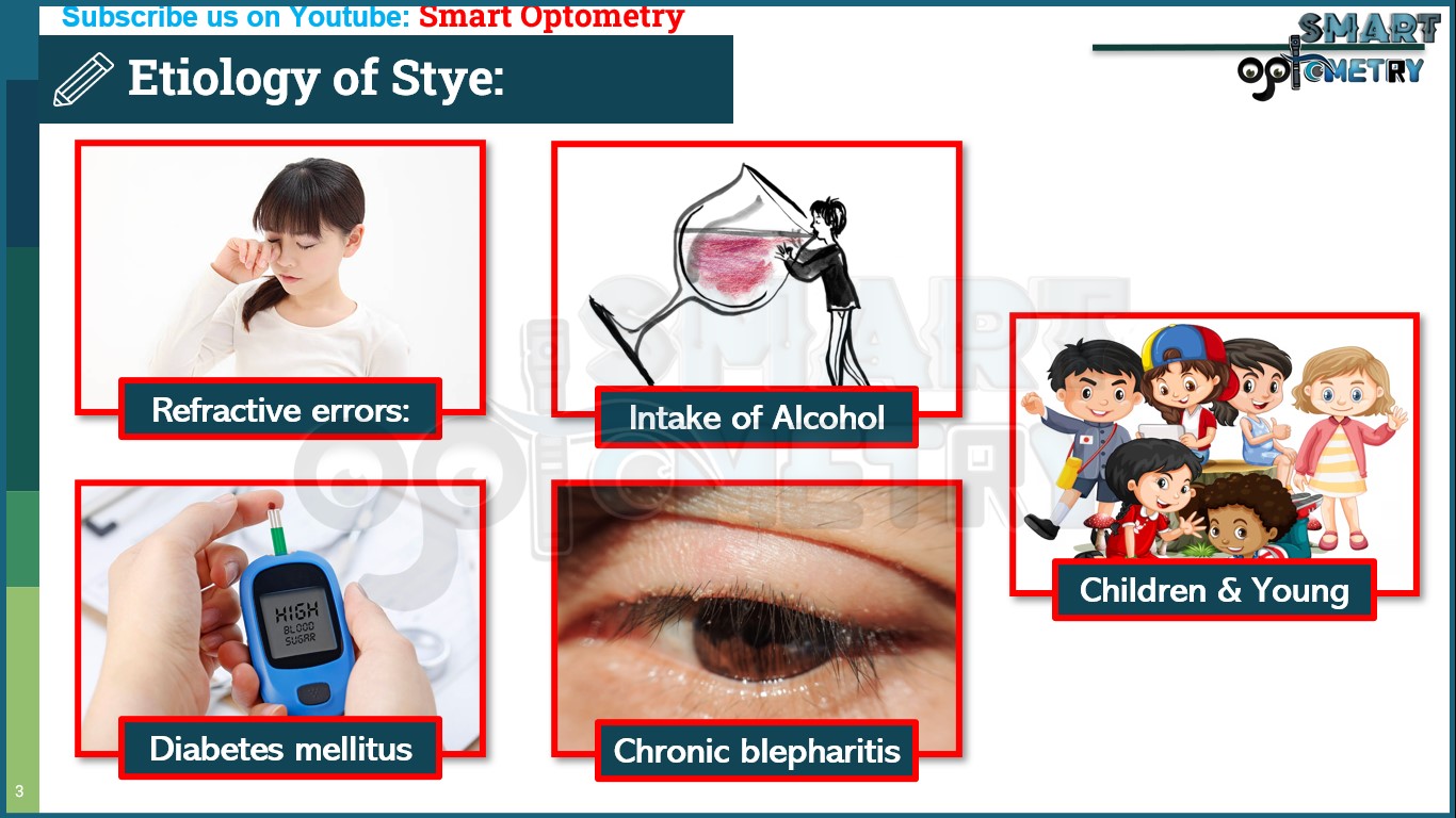 External Hordeolum or Stye- Everything you Need to Know - Smart Optometry