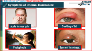 Internal Hordeolum – Definition, Causes, Symptoms, Signs, Treatment ...