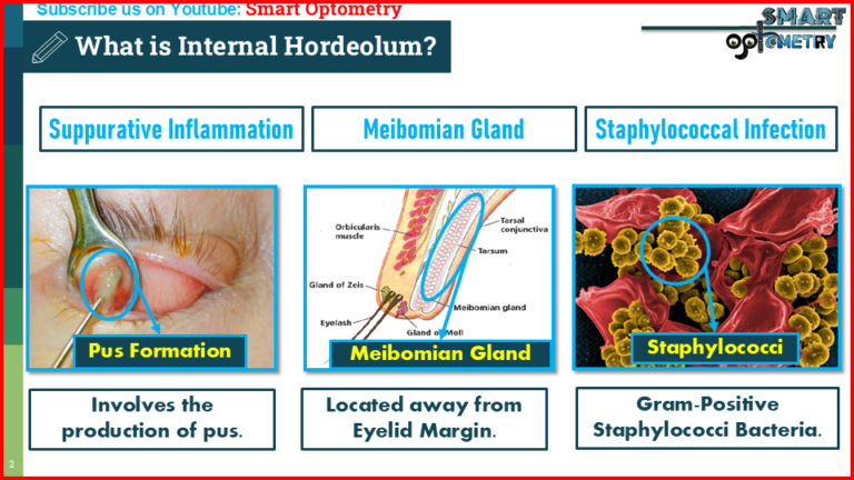 Internal Hordeolum – Definition, Causes, Symptoms, Signs, Treatment ...