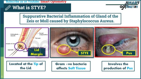 External Hordeolum or Stye- Everything you Need to Know - Smart Optometry