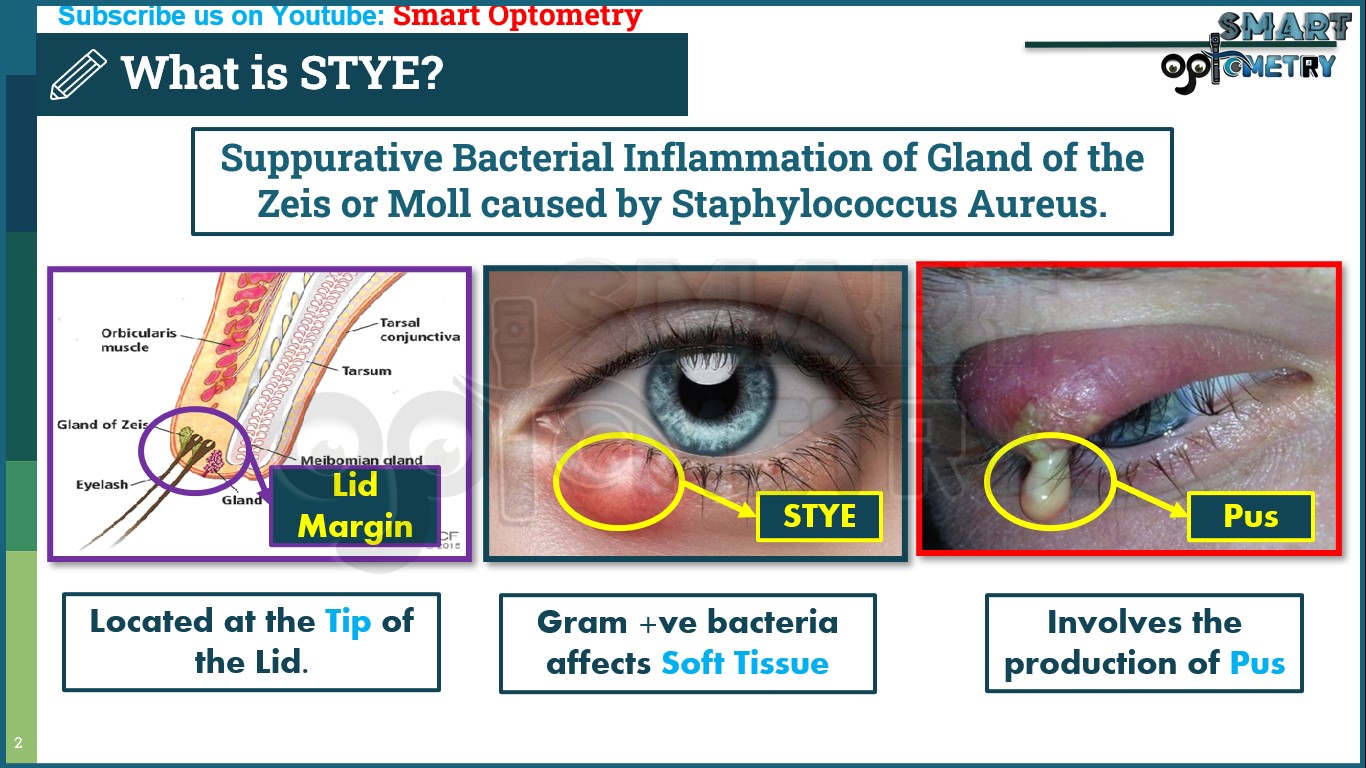 External Hordeolum or Stye- Everything you Need to Know - Smart Optometry