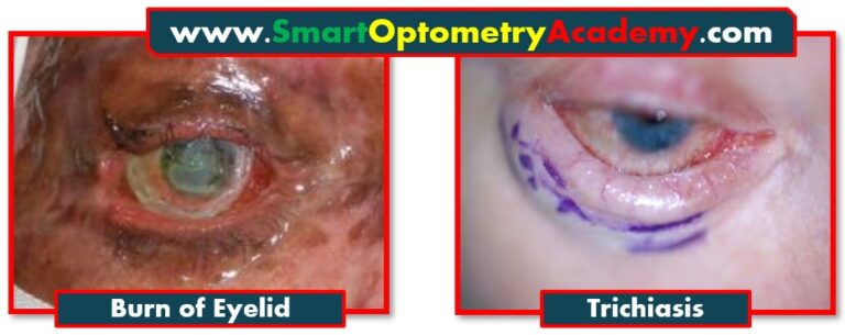 Trichiasis- Definition, Causes, Symptoms, Signs & Treatment. - Smart ...