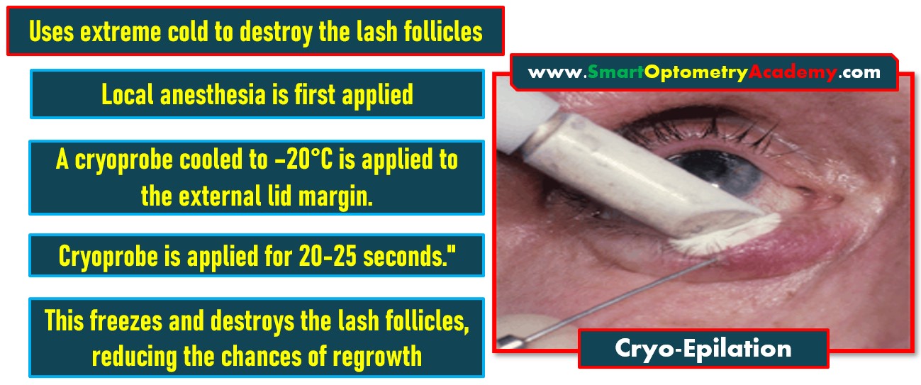 Trichiasis- Definition, Causes, Symptoms, Signs & Treatment. - Smart ...