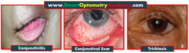 Trichiasis- Definition, Causes, Symptoms, Signs & Treatment. - Smart ...