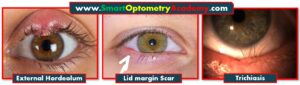 Trichiasis- Definition, Causes, Symptoms, Signs & Treatment. - Smart ...