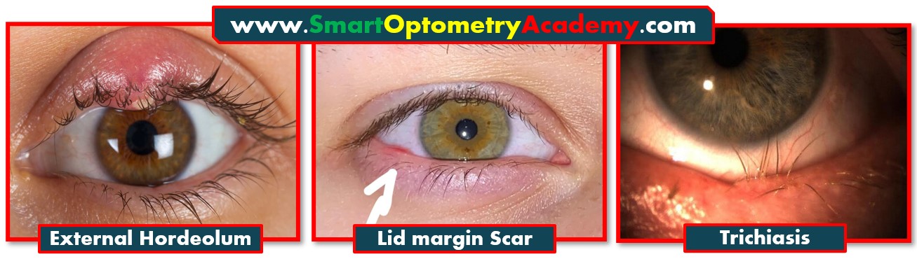 Trichiasis- Definition, Causes, Symptoms, Signs & Treatment. - Smart ...