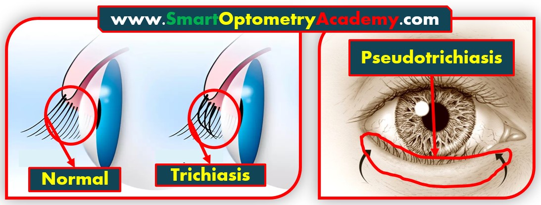 Trichiasis- Definition, Causes, Symptoms, Signs & Treatment. - Smart ...