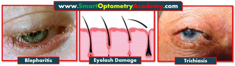 Trichiasis- Definition, Causes, Symptoms, Signs & Treatment. - Smart ...