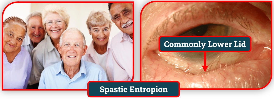 Entropion- Definition, Types, Symptoms, Signs & Treatment. - Smart ...
