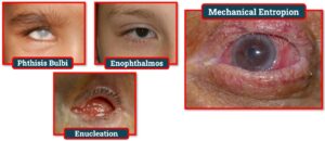 Entropion- Definition, Types, Symptoms, Signs & Treatment. - Smart ...