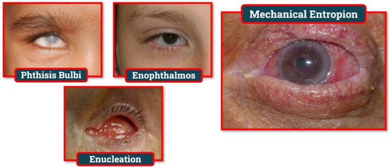 Entropion- Definition, Types, Symptoms, Signs & Treatment. - Smart ...