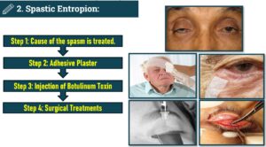 Entropion- Definition, Types, Symptoms, Signs & Treatment. - Smart ...