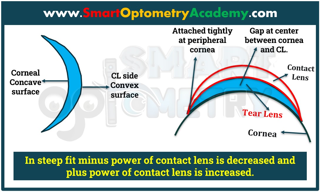 Contact Lens- Over Refraction Calculation in Just 3 Simple Steps ...